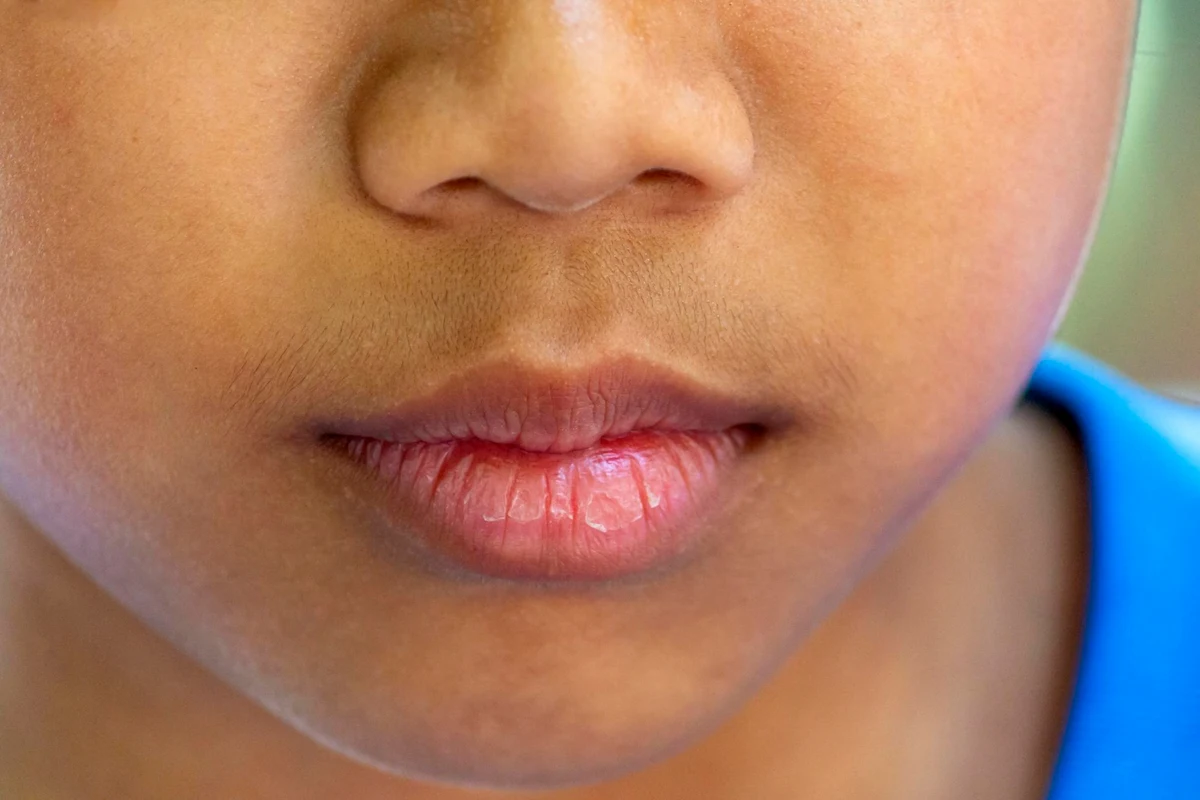 Hirsutism: Causes and Effective Hair Removal Treatment